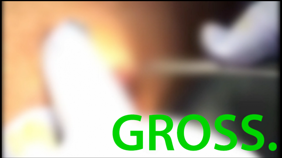 Graphic Video of a Belize Botfly Removal | RTM - RightThisMinute