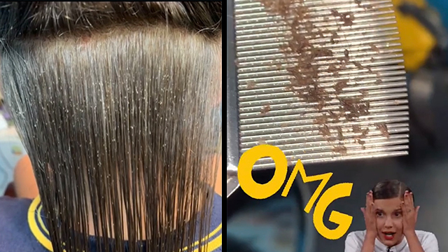 Here’s What Happens When You Don’t Treat Lice | RTM - RightThisMinute